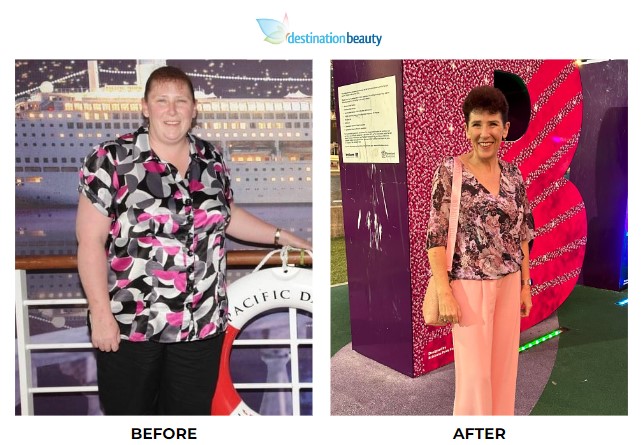 Alison had skin removal surgery after losing 45 kg