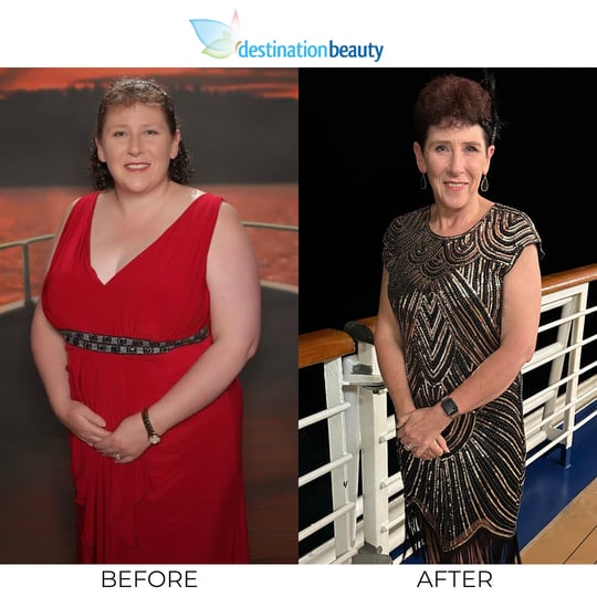 Alison had weight loss surgery in Thailand