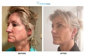 Antonia is now looking 10 years younger after facelift in Thailand