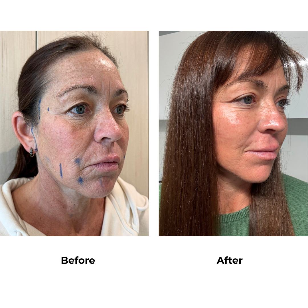 Brooke had facelift surgery in Thailand with Dr. NJ