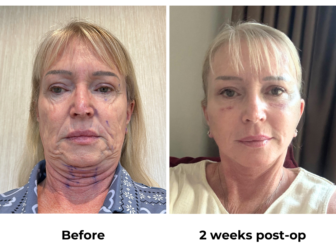 Dawn had a facelift in Thailand with Dr. NJ