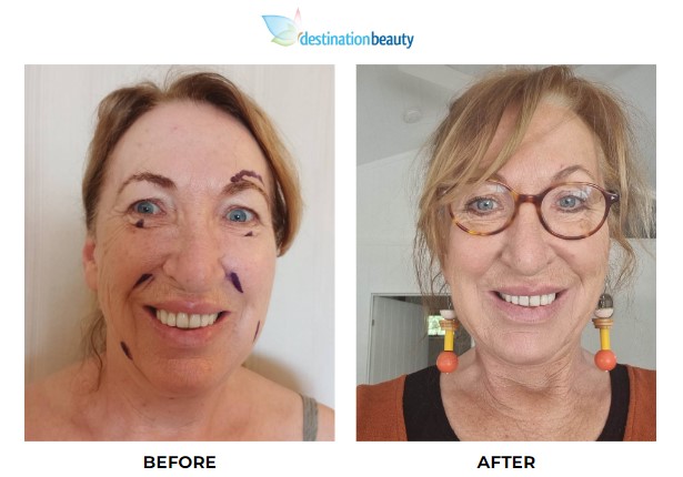 Georgina is looking 10 years younger after facelift surgery