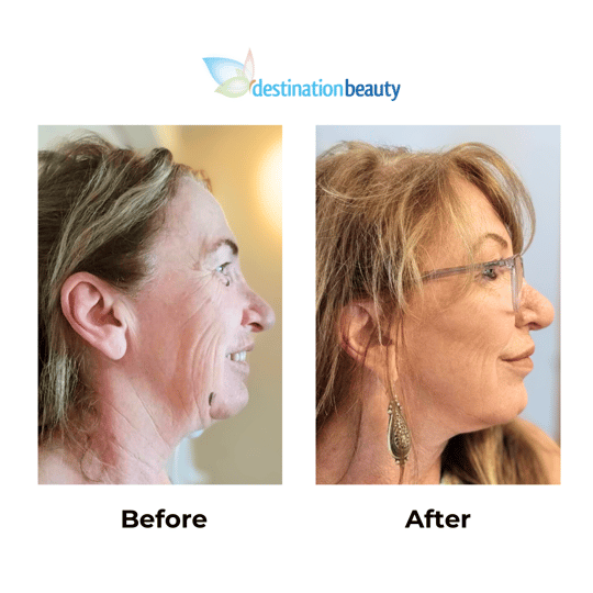 Georgina is looking 10 years younger after facelift surgery
