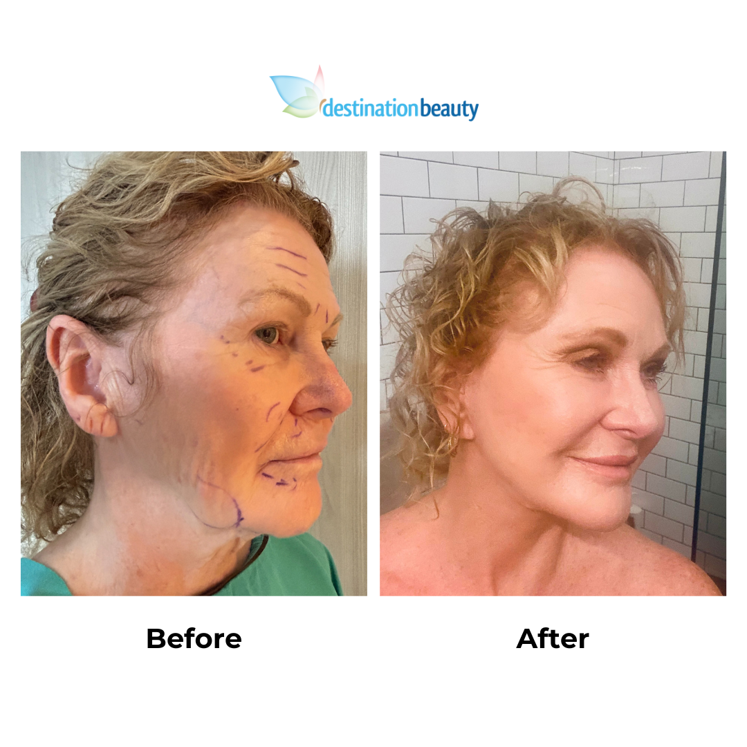 Jennie had facelift surgery in Thailand