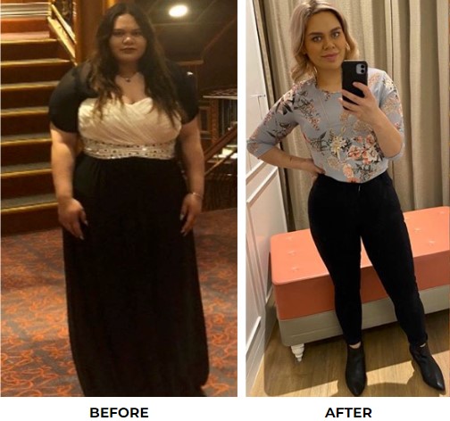 Kay had Gastric Sleeve Surgery in Thailand - Destination Beauty