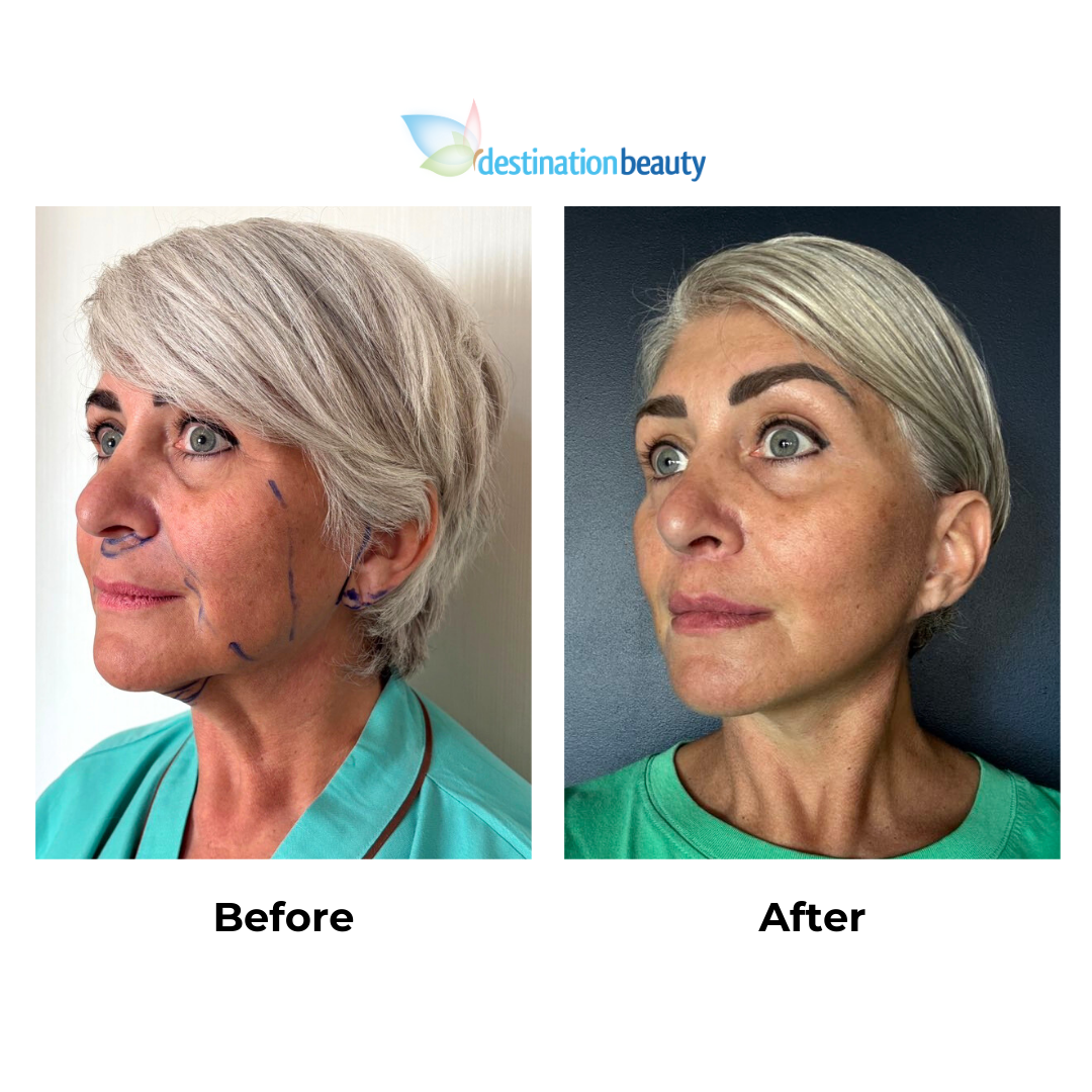 Lily had a facelift surgery in Thailand with Dr. NJ