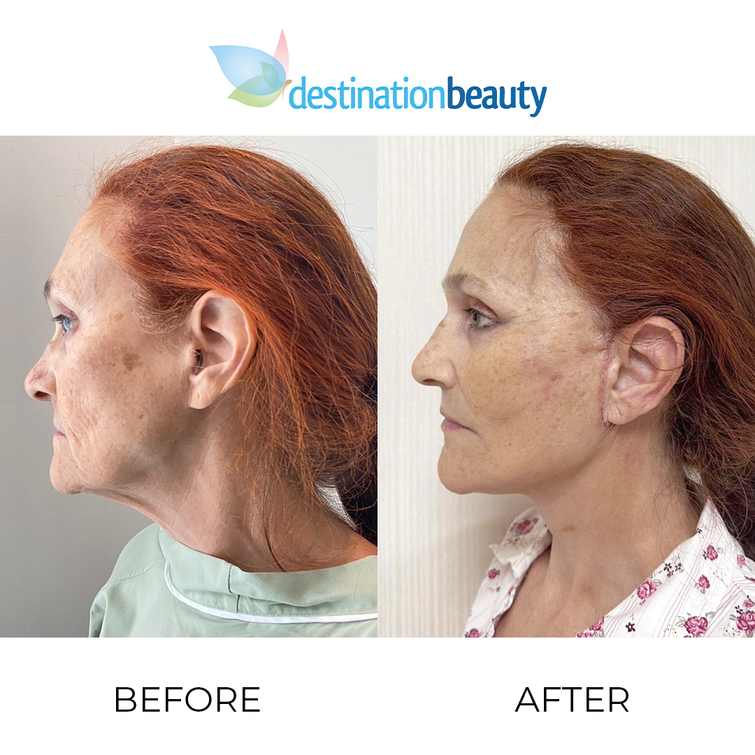 Lorae is now looking 15 years younger after facelift surgery in ...