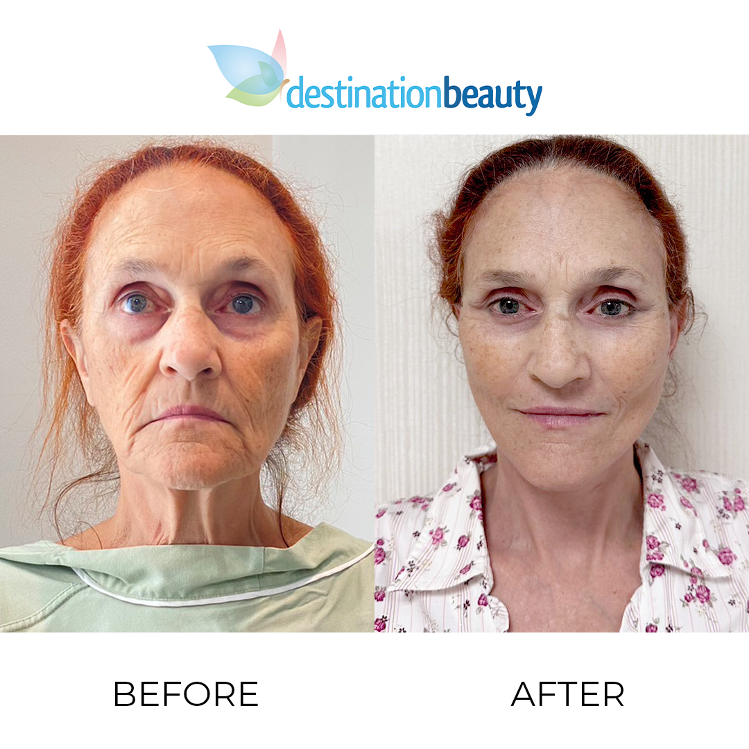 Lorae is now looking 15 years younger after facelift surgery in ...