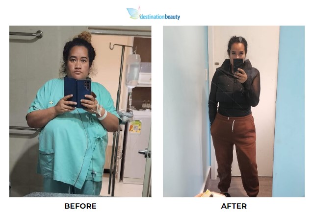 Misty lost 50 kg 9 months after weight loss surgery in Thailand
