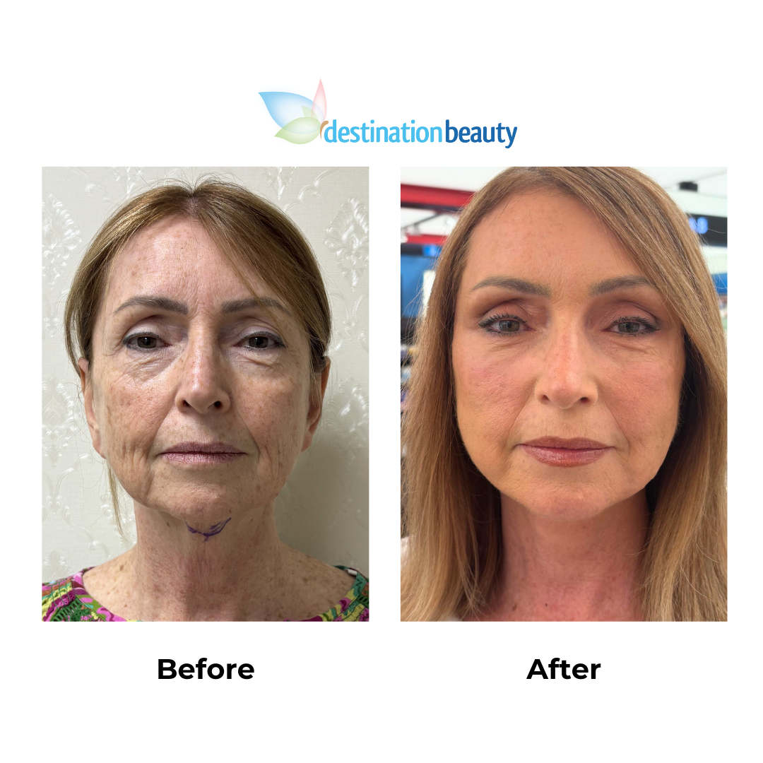 Tracy had a facelift surgery in Thailand with Dr. Ring