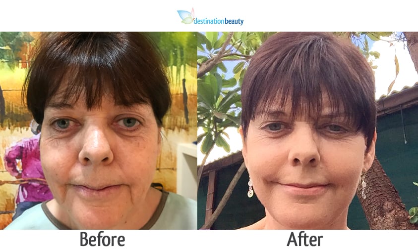 Venessa is now looking 10 years younger after face lift in Thailand