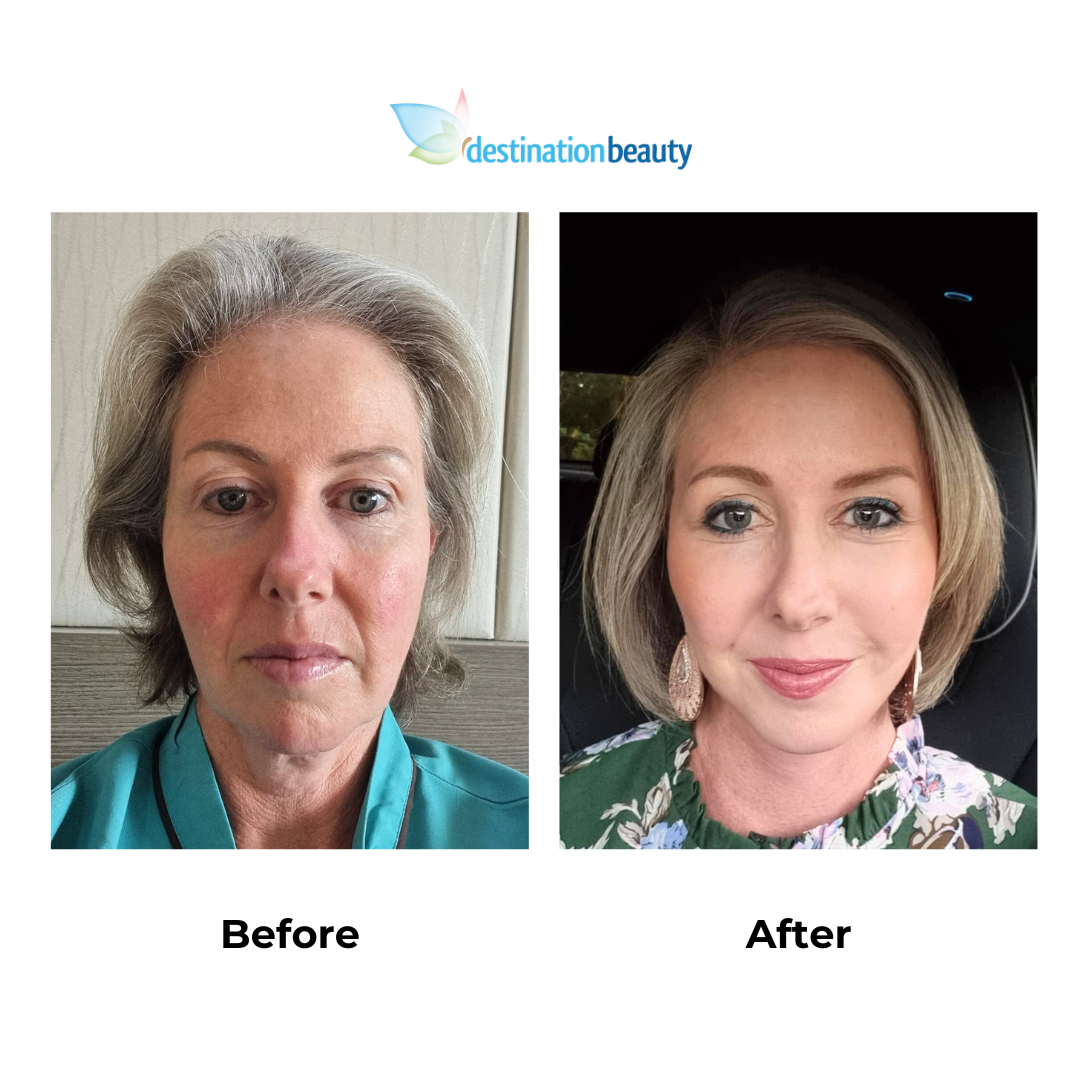 Vicky had a facelift surgery in Thailand
