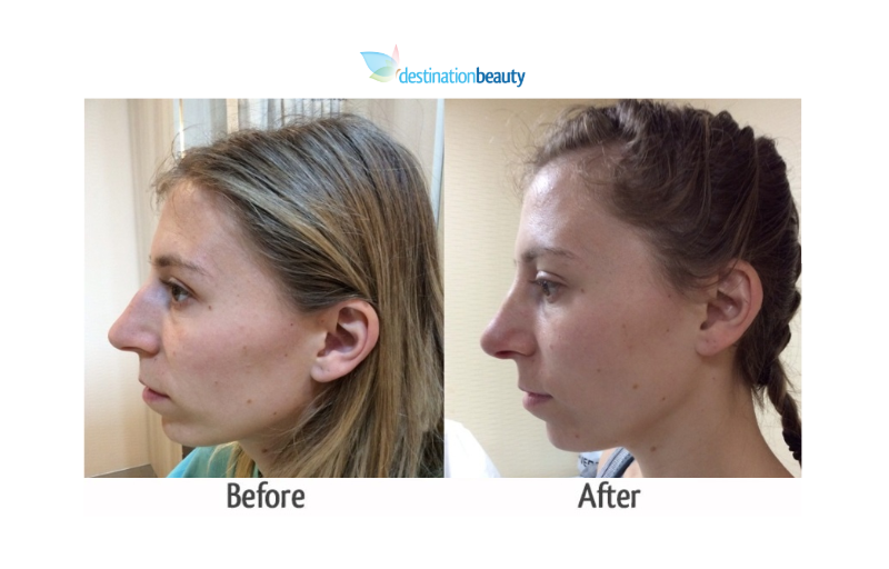 Rhagan's nose reshaping in Thailand