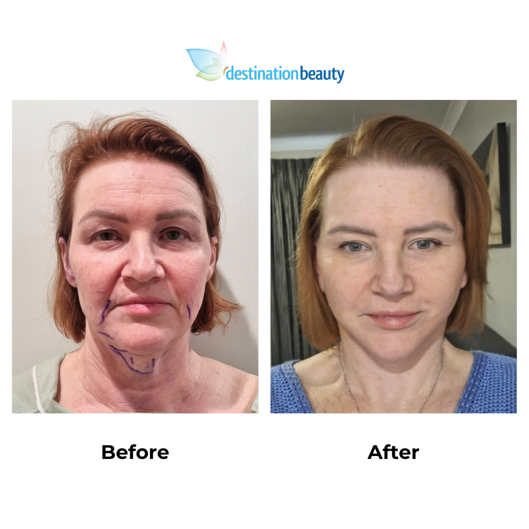 Angela had a facelift surgery in Thailand with Dr. NJ