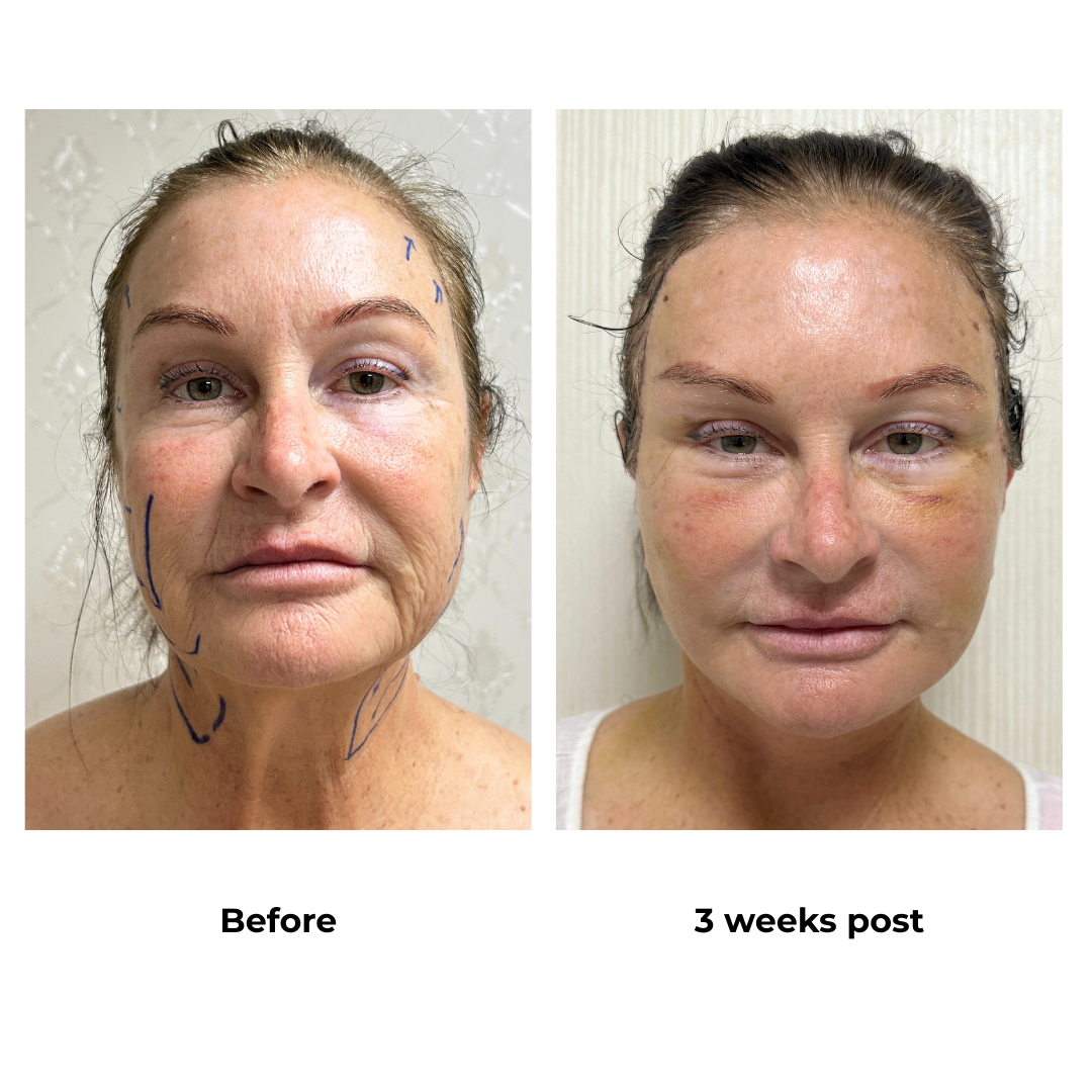 Barbara had a facelift with Dr. Ring in Thailand