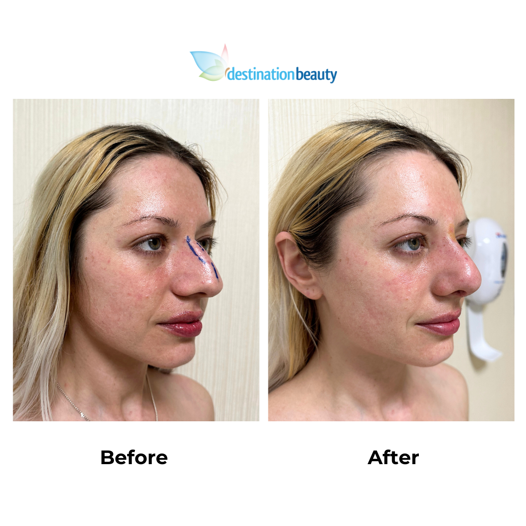 Jessica had nose surgery in Thailand with Dr. Ring