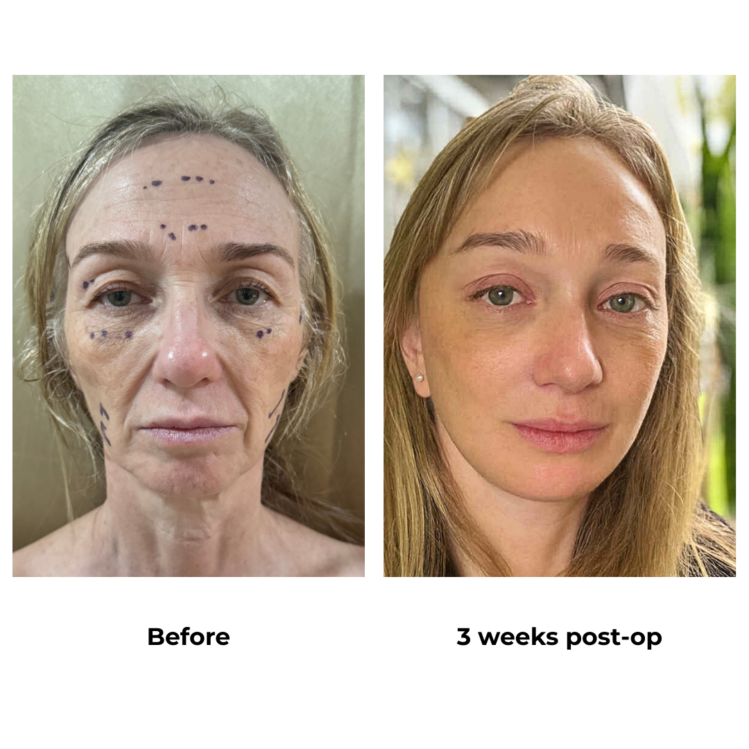 Lisa's facelift transformation in Thailand