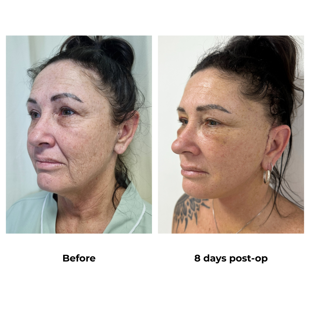 Michelle had facelift surgery with Dr. NJ in Thailand
