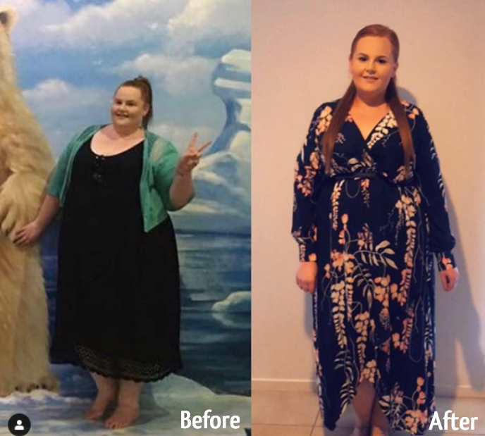Samantha had full body lift surgery with in Thailand after losing 100 kgs!